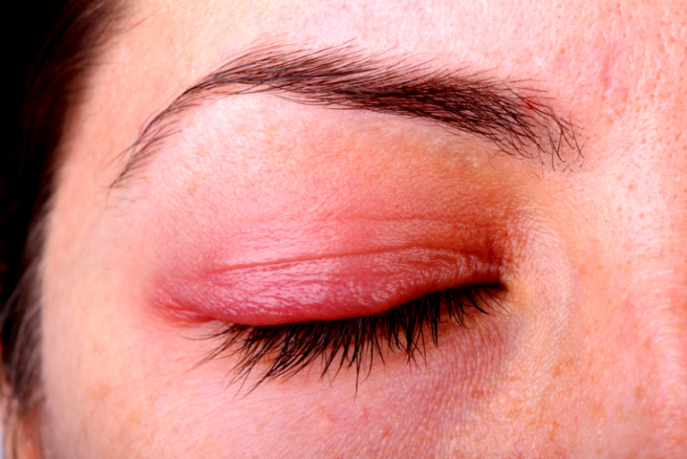 How to Detect If You Have Ocular Rosacea or Common Eye Allergy?
